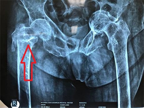 INTERTROCHANTERIC - SUBTROCHANTERIC FRACTURE | Γεώργιος Δ. Γκουδέλης