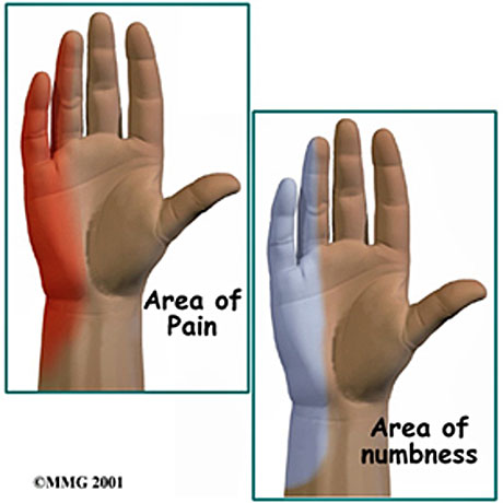 CUBITAL TUNNEL SYNDROME | Γεώργιος Δ. Γκουδέλης