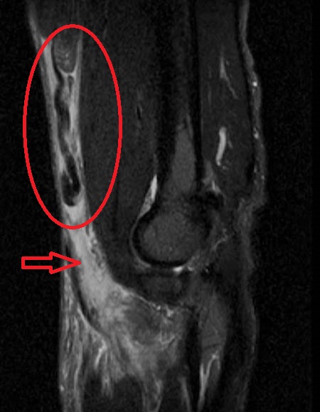 DISTAL BICEPS TENDON RUPTURE | Γεώργιος Δ. Γκουδέλης