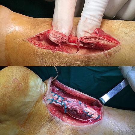 ACHILLES TENDON RUPTURE | Γεώργιος Δ. Γκουδέλης